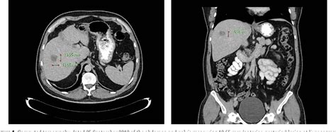 Pdf Complete Resolution Of Rectal Cancer With Liver Metastases After