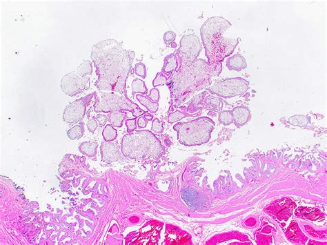 Pathology Outlines Cholesterol Polyp