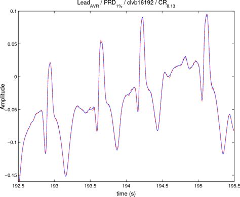 Figure 16 From A Low Computational Complexity Algorithm For Ecg Signal