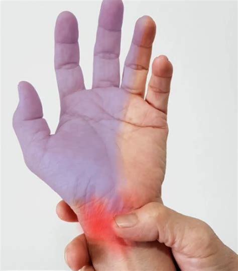 Sering Kali Anda Mengalami Kesemutan Ini Dia Penybab Dan Cara