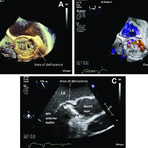 Transesophageal Echocardiogram Performed Day 14 Of Admission Download Scientific Diagram
