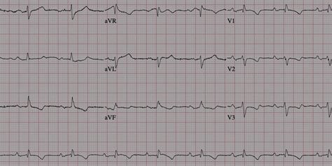 ECG Or PPG What Are They And Which Is Better