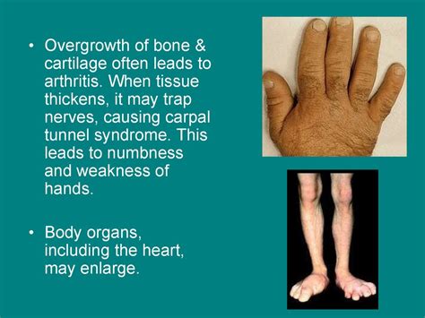Acromegaly Description презентация онлайн