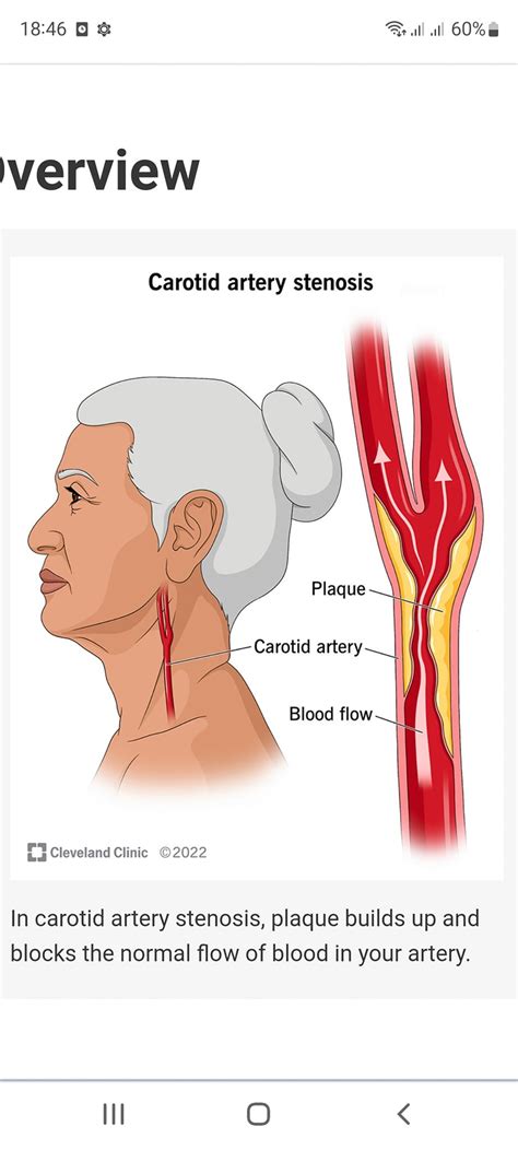 Ariuntuya 💚Мэдрэлийн нарийн мэргэжлийн эмчийн үзлэг оношилгоо хийж мөн 💚Тархины судасны өнгөт