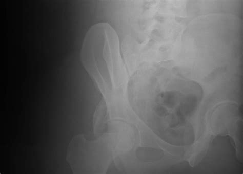 Acetabular Fractures Trauma Orthobullets