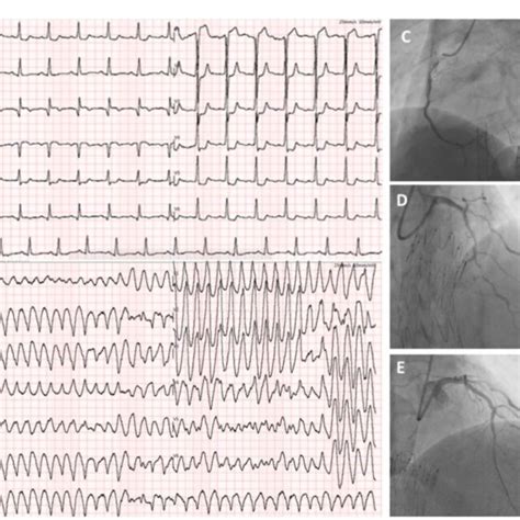 Figure Ecg Showing St Elevation In Vv And St Depression In I Avl And Download Scientific