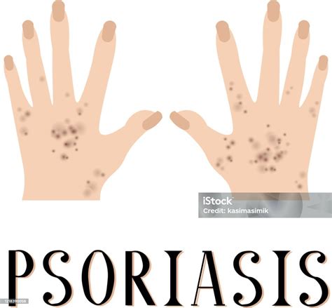 건 선의 병에 걸린 피부 아픈 손 의료 포스터입니다 피부과 및 성병학 건강 진단에 대한 스톡 벡터 아트 및 기타 이미지 건강 진단 건강관리와 의술 건강한 생활방식