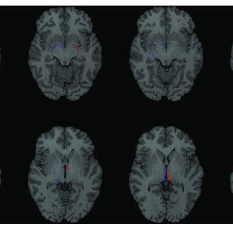 using multi shell clinical grade dmri data to reconstruct the