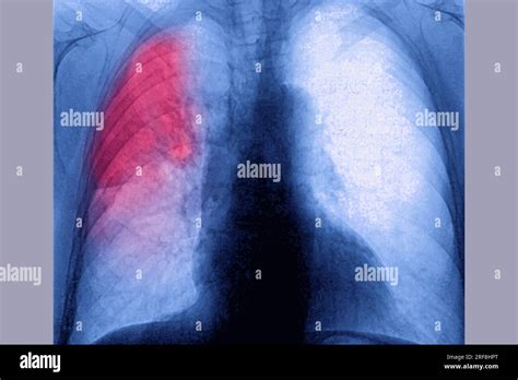 Pneumonia In A Right Lung Acute Respiratory Infection Revealed By