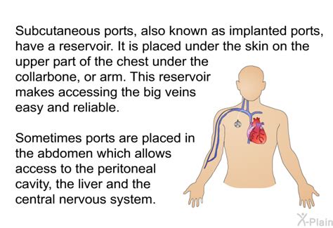PatEdu Com Port Catheter Insertions