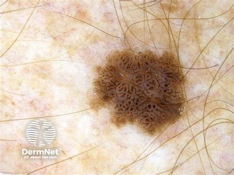 Dermoscopy Seborrhoeic Keratosis With Cerebriform Structures Image