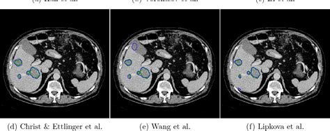 [pdf] The Liver Tumor Segmentation Benchmark Lits Semantic Scholar