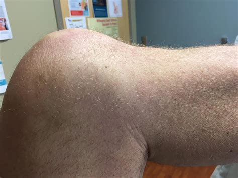 Sag Sign For Posterior Cruciate Ligament At Laura Hefley Blog