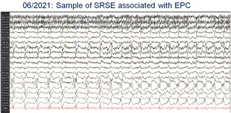 Super Refractory Focal Status Epilepticus Treated By Resective Surgery And Vagal Nerve