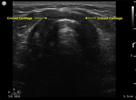 Airway Management With Point Of Care Ultrasound A Breath Of Fresh Air