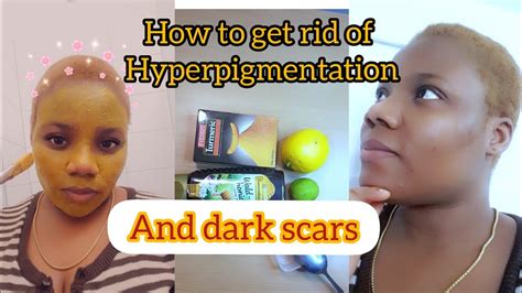 Get Rid Of Hyperpicmentation And Dark Scars Youtube Get Rid Of Hyperpicmentation And Dark Scars Youtube