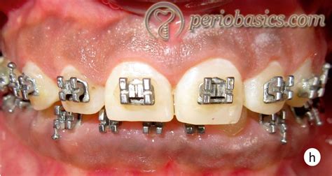 Gingivectomy And Gingivoplasty