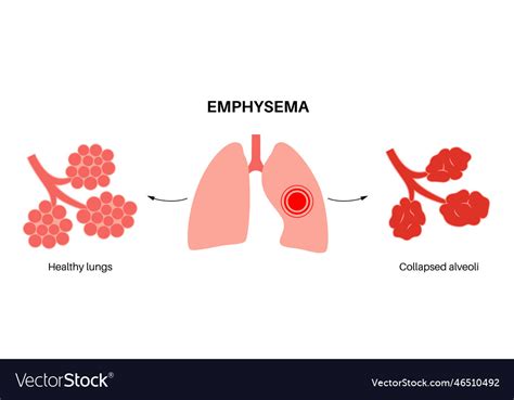 Emphysema Anatomical Poster Royalty Free Vector Image