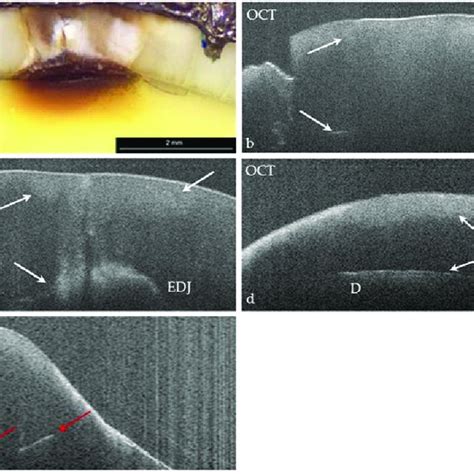 A Extracted Human Molar A Carious Lesion Icdas Ii Code 2 Without