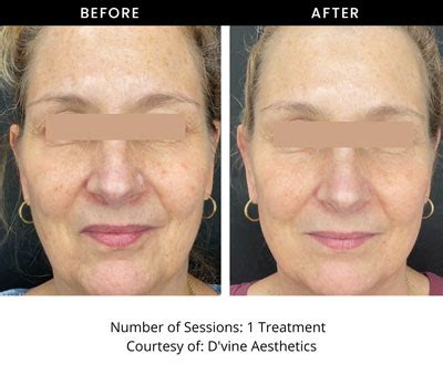 Before And After Photos Of Renouveau Med Spa Renouveau