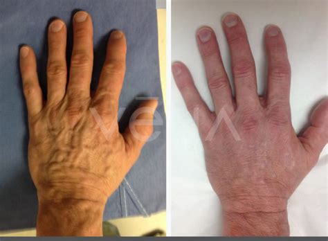 Vena Hand Veins