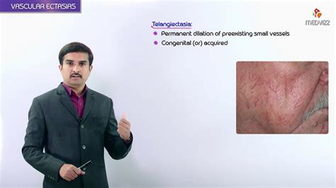 Nevus Flammeus