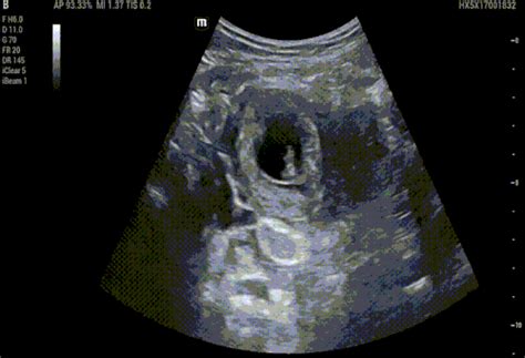 Oh Man Interstitial Ectopic — Kwak Talk