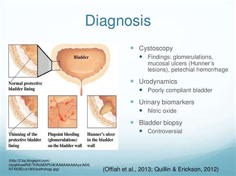 Interstitial Cystitis