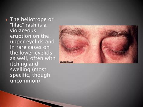 Dermatomyositis Dr Saad Raheem Abed Pptx Skin And Dermatology