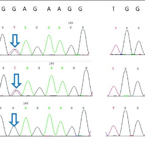Sanger Sequencing Validation Of The Ttc7a Variants Download