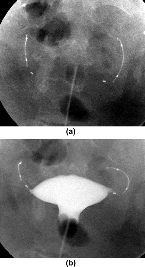 Multimodality Imaging Of The Essure Tubal Occlusion Device Clinical