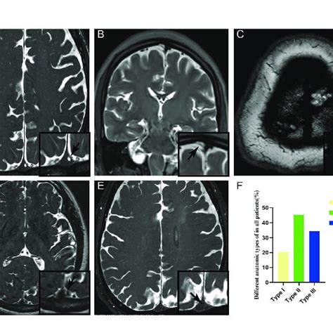 Three Types Of Arachnoid Granulation In The Superior Sagittal Sinus