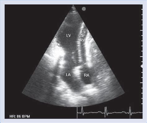 Apical Four Chamber Window Of Transthoracic Echocardiography Showing A