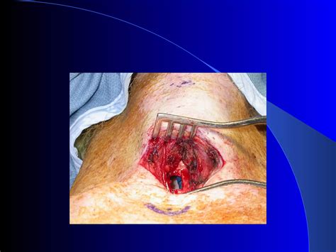 Tracheostomy And Post Op Care Ppt