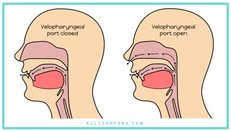 Common Cleft Palate Speech Compensatory Errors