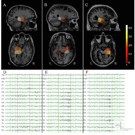 Representative Samples Of Statistical Parametric Mapping Spm Of