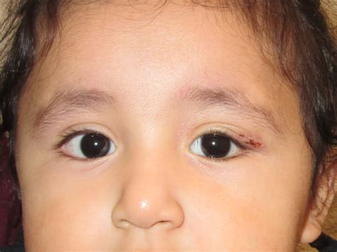 Dermoid Pediatric Eye Md Pediatric Ophthalmologists In Fresh