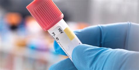 Evolution Of High Sensitivity Hiv Testing Beckman Coulter