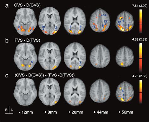 Cortical Activation During Performance Of Feature And Conjunction Download Scientific Diagram