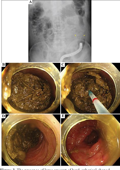 Figure 2 From A Case Of Colonic Fecal Impaction Caused By Excessive