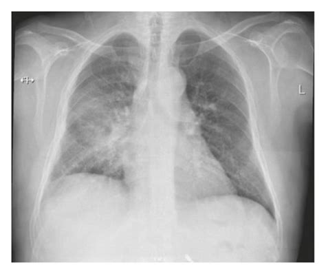 Chest X Ray Showing Right Lower Zone Non Homogenous Opacity With Air