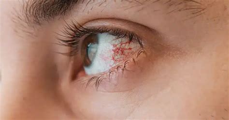 Punctate Keratitis Everything You Need To Know