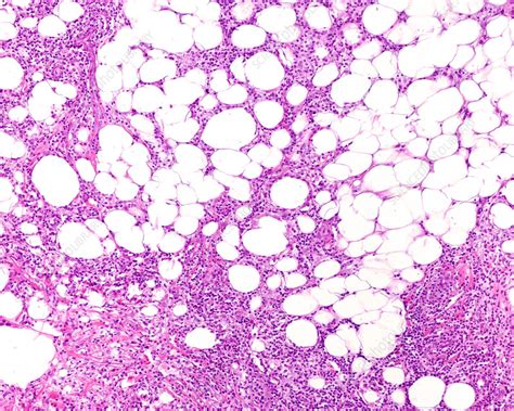 Fat Necrosis Of The Breast Light Micrograph Stock Image C0580359