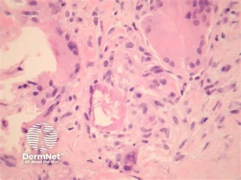 Erythema Nodosum Pathology