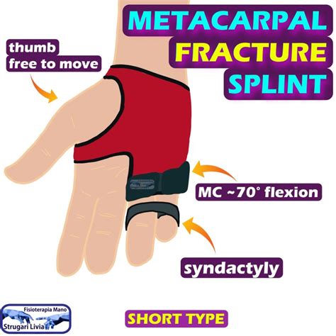 Livia Strugari On Linkedin Metacarpal Fracture Splint Short Type 🫶 🫶 🫶