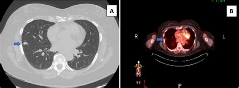 Lobe Pulmonary Nodule