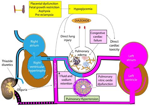 Diazoxide For Neonatal Hyperinsulinemic Hypoglycemia And Pulmonary