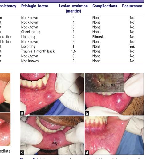 Figure 2 Micro Marsupialization Versus Surgical Excision