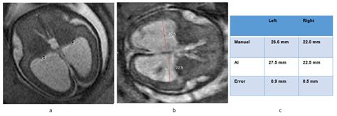 Diagnostics Free Full Text Automatic Ventriculomegaly Detection In Fetal Brain Mri A Step