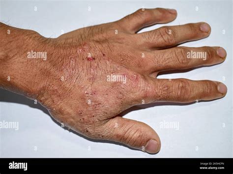 Ringworm On Hands